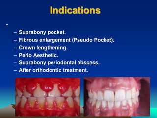 Gingivectomy .. periodontal diseases lect.Asma'a.pptx