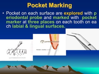 Gingivectomy .. periodontal diseases lect.Asma'a.pptx