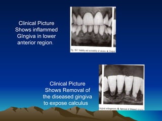 Gingivectomy | PPT