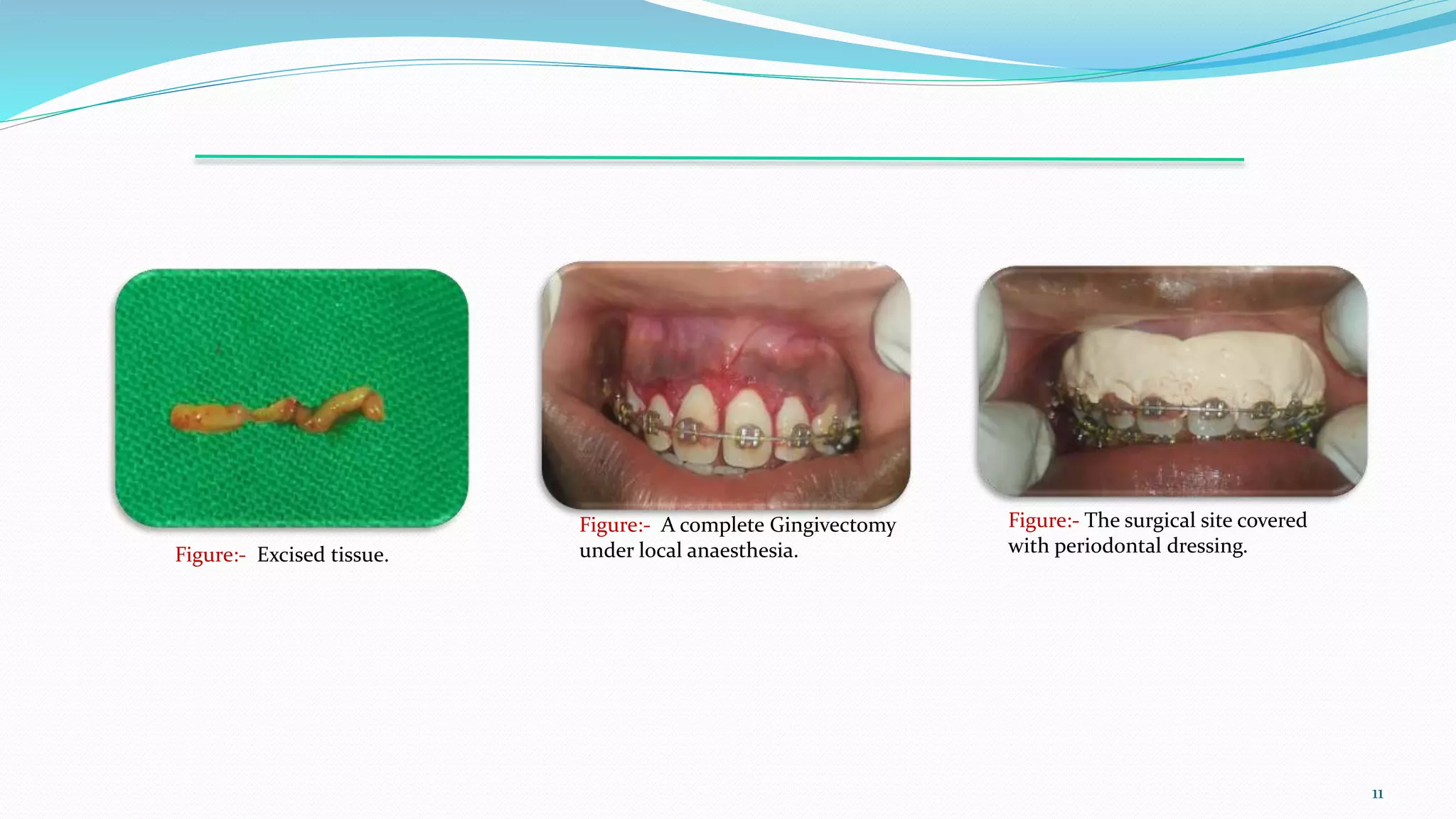 Gingivectomy ppt | PPTX