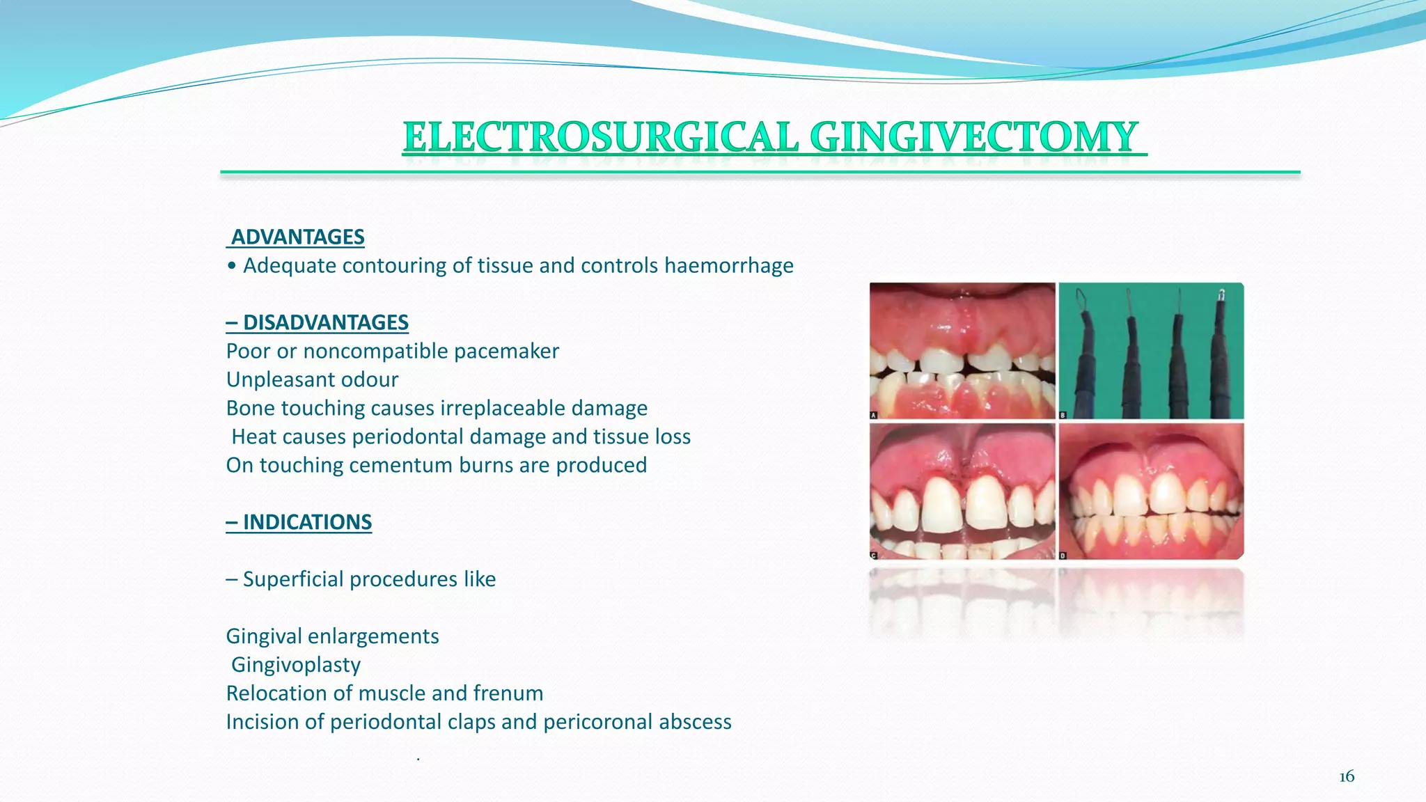 Gingivectomy ppt | PPTX