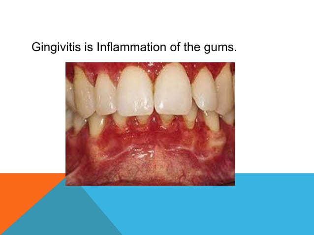 Gingivitis | PPTX