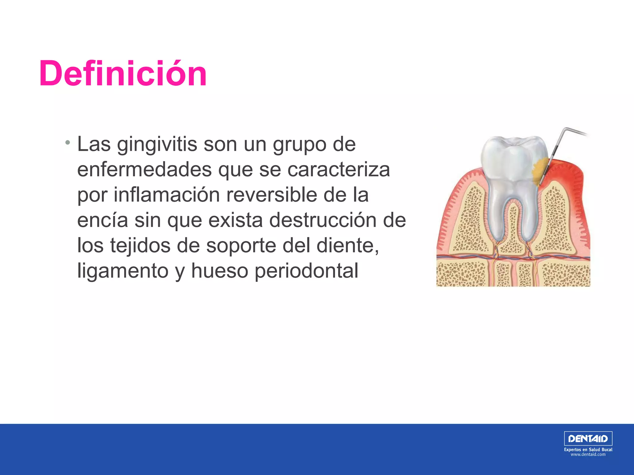 Gingivitis | PPT | Dental Health | Diseases and Conditions