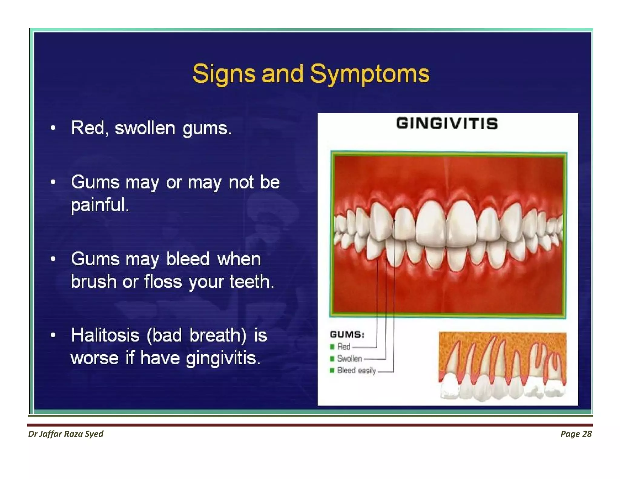 Gingivitis | PDF