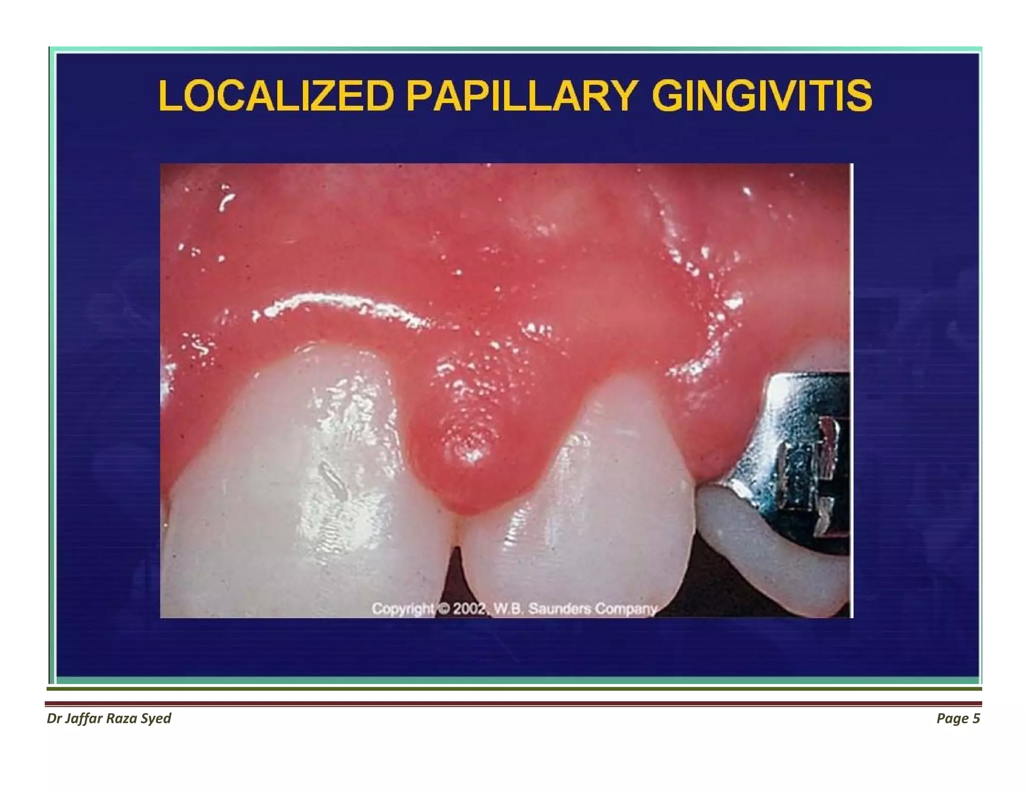 Gingivitis | PDF