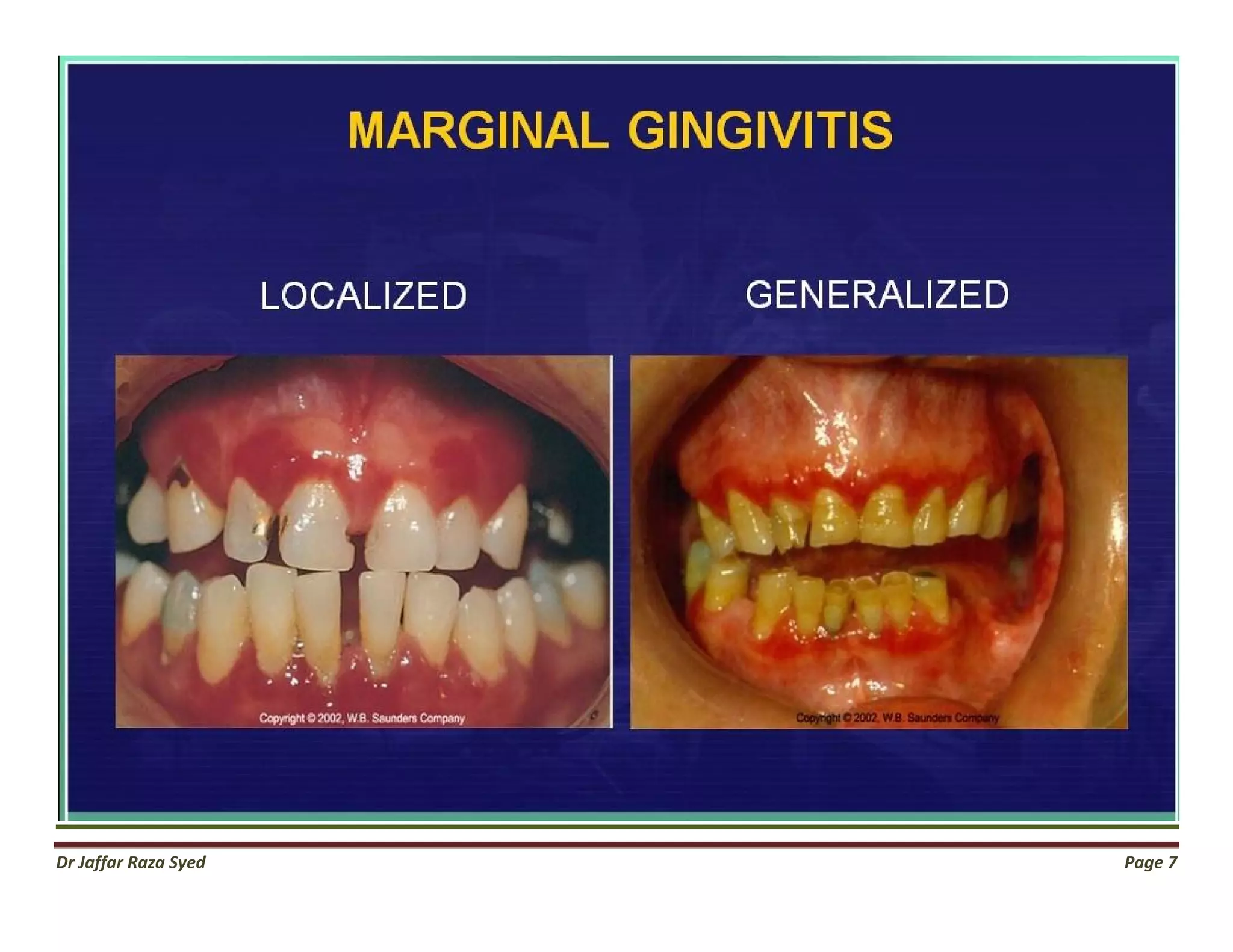 Gingivitis | PDF