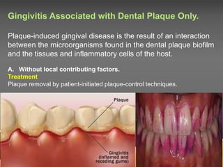 Gingivitis | PPTX