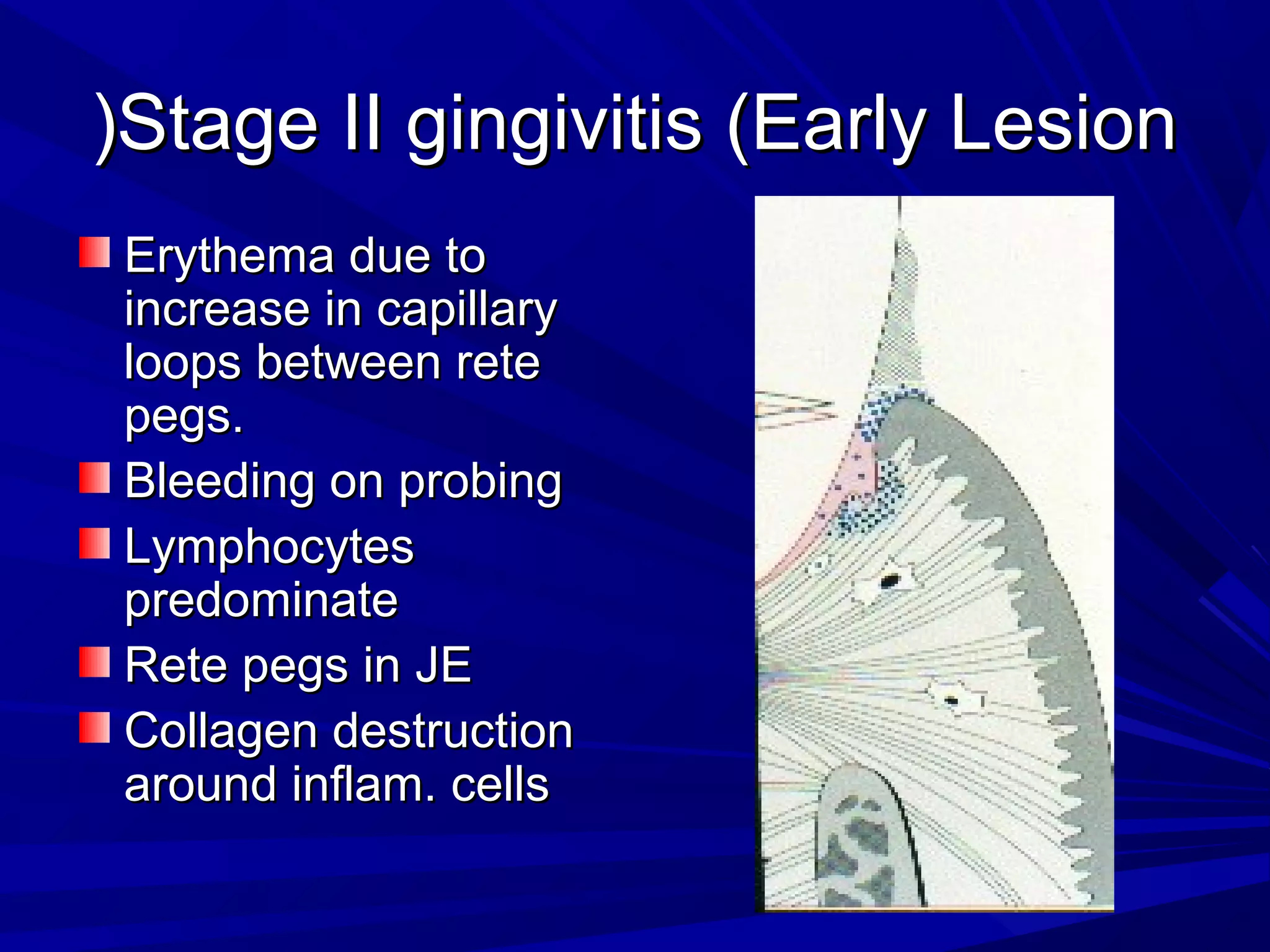 Gingivitis | PPT