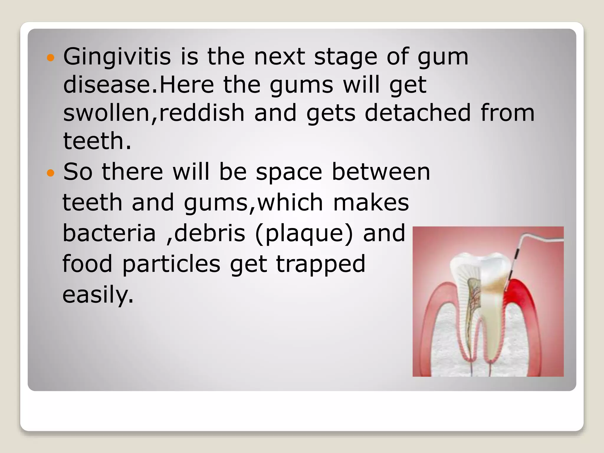 Gingivitis | PPTX