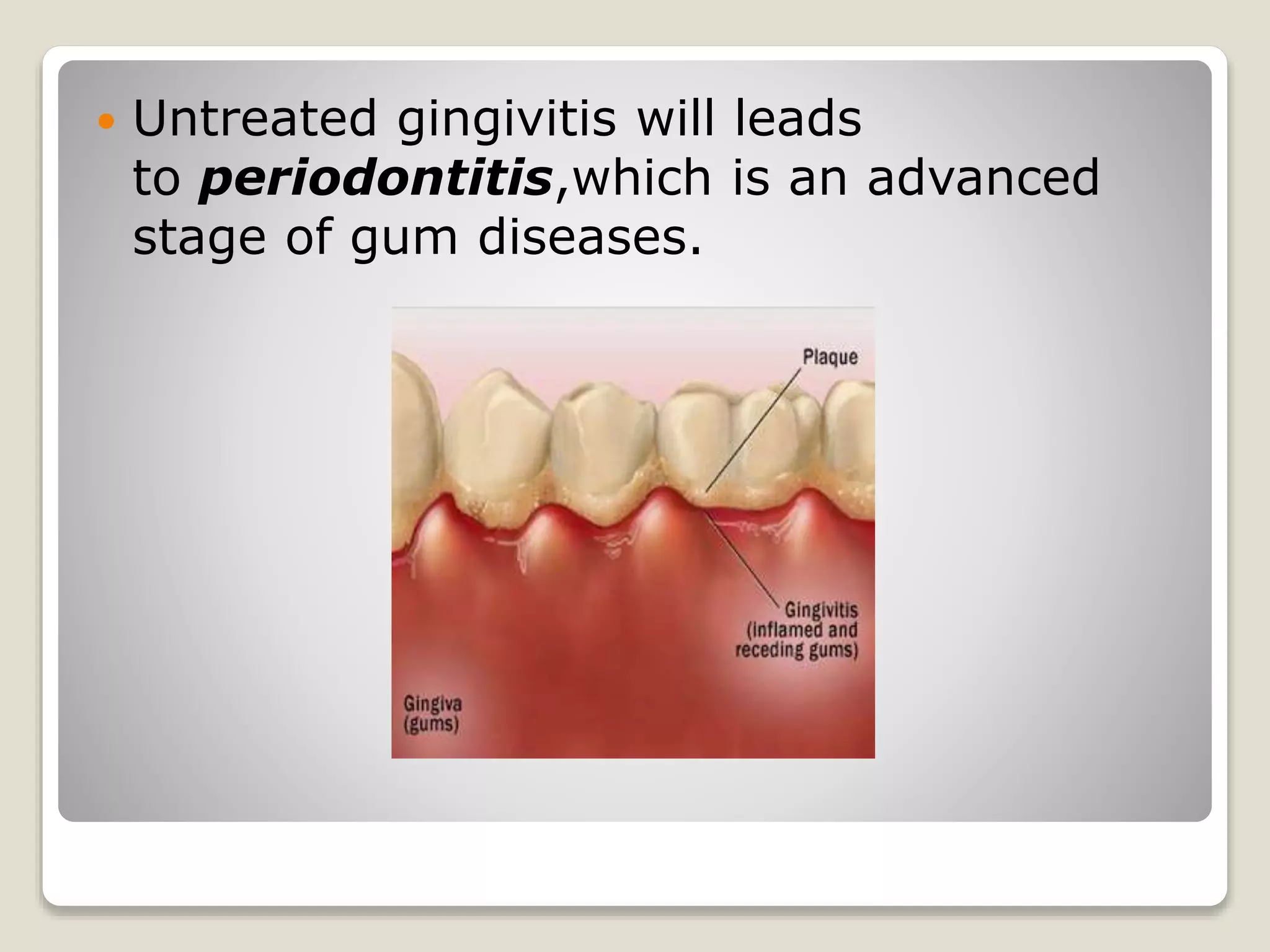 Gingivitis | PPTX