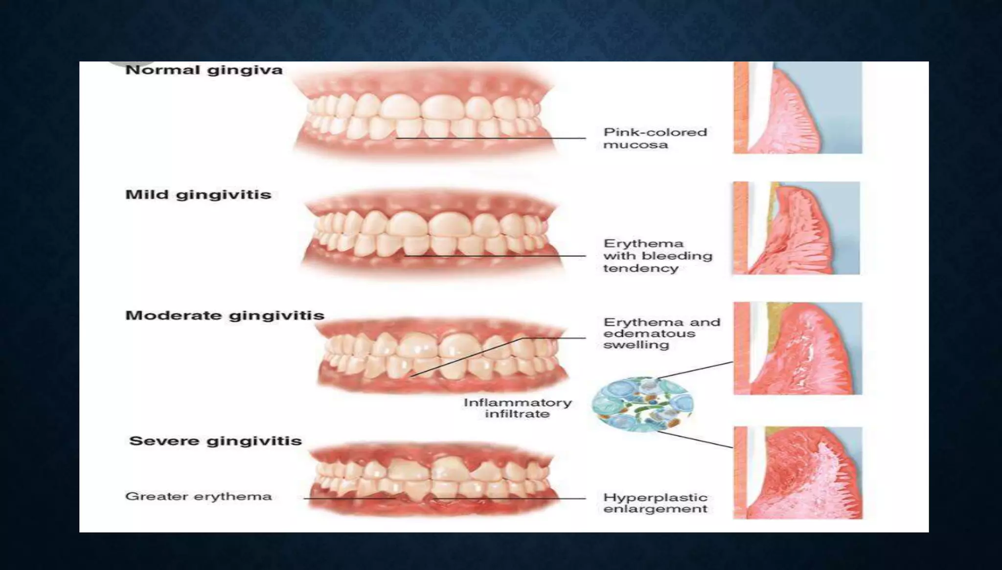 Gingivitis | PPTX
