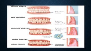 Gingivitis | PPTX