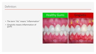 Gingivitis or gingival inflammation | PPT