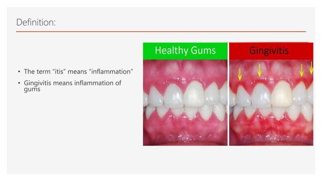 Gingivitis or gingival inflammation | PPTX