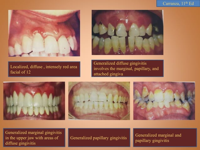 Gingivitis | PPTX