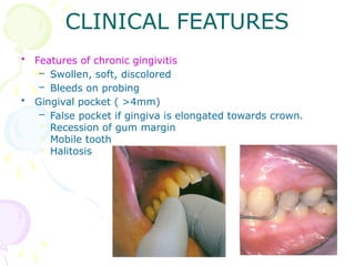 gingivitis for dentistry students .pptx