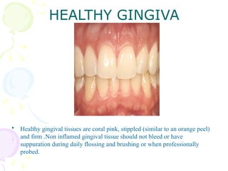 gingivitis for dentistry students .pptx