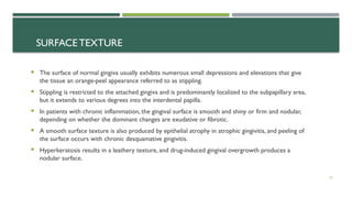 Gingivitis | PPTX