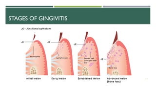 Gingivitis | PPTX