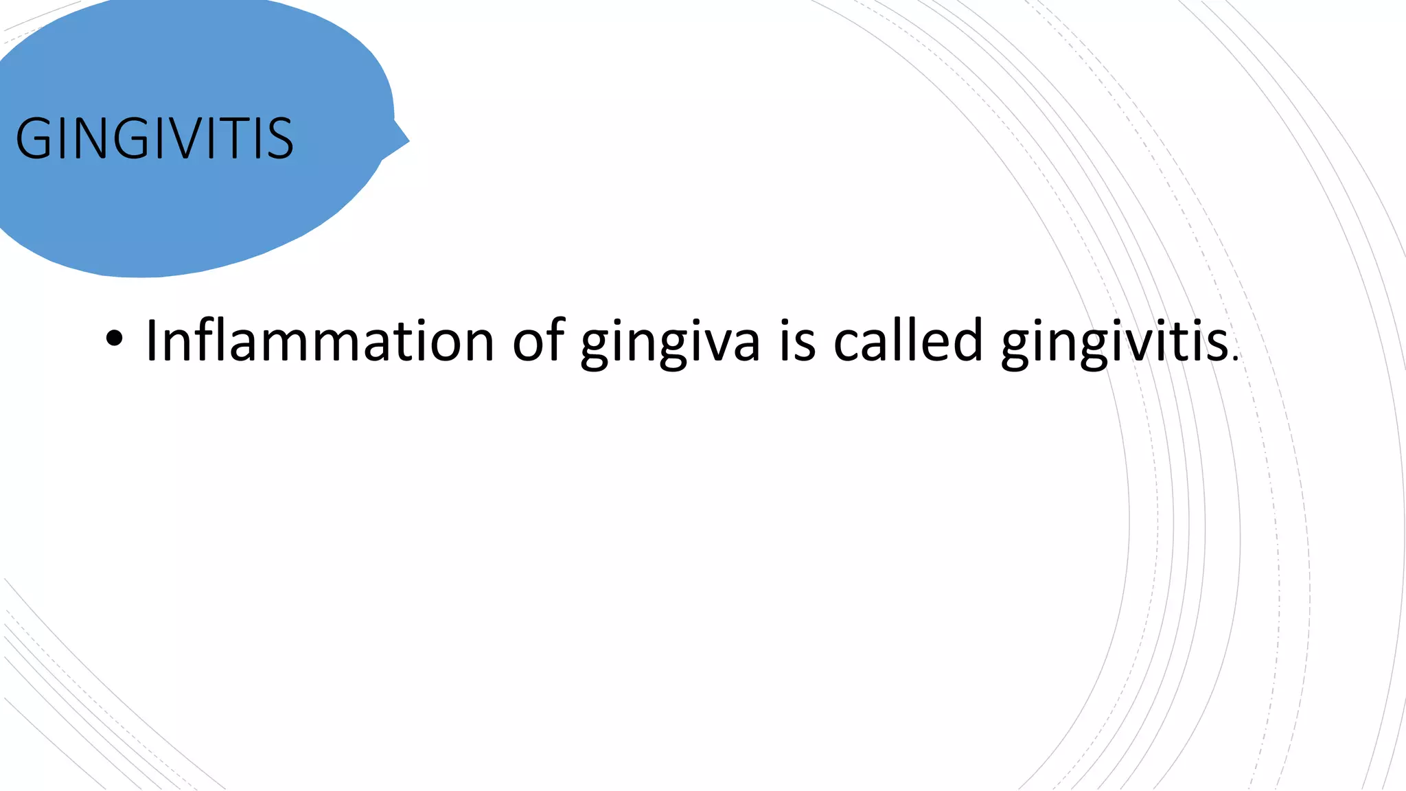 Gingivitis main | PPTX