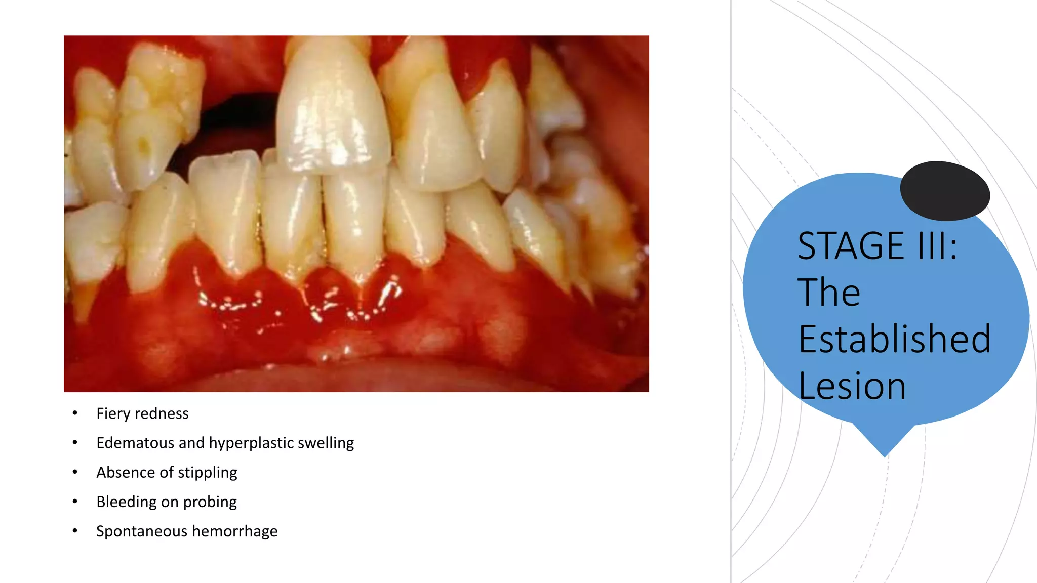 Gingivitis main | PPTX
