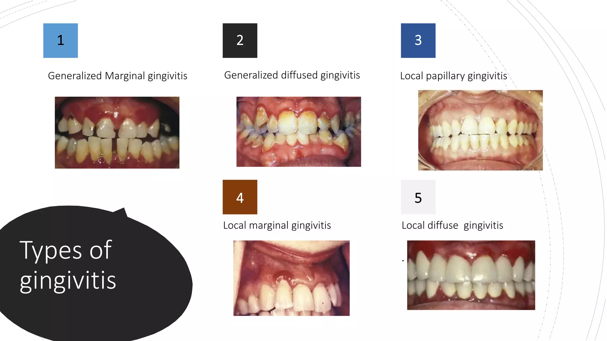 Gingivitis main | PPTX