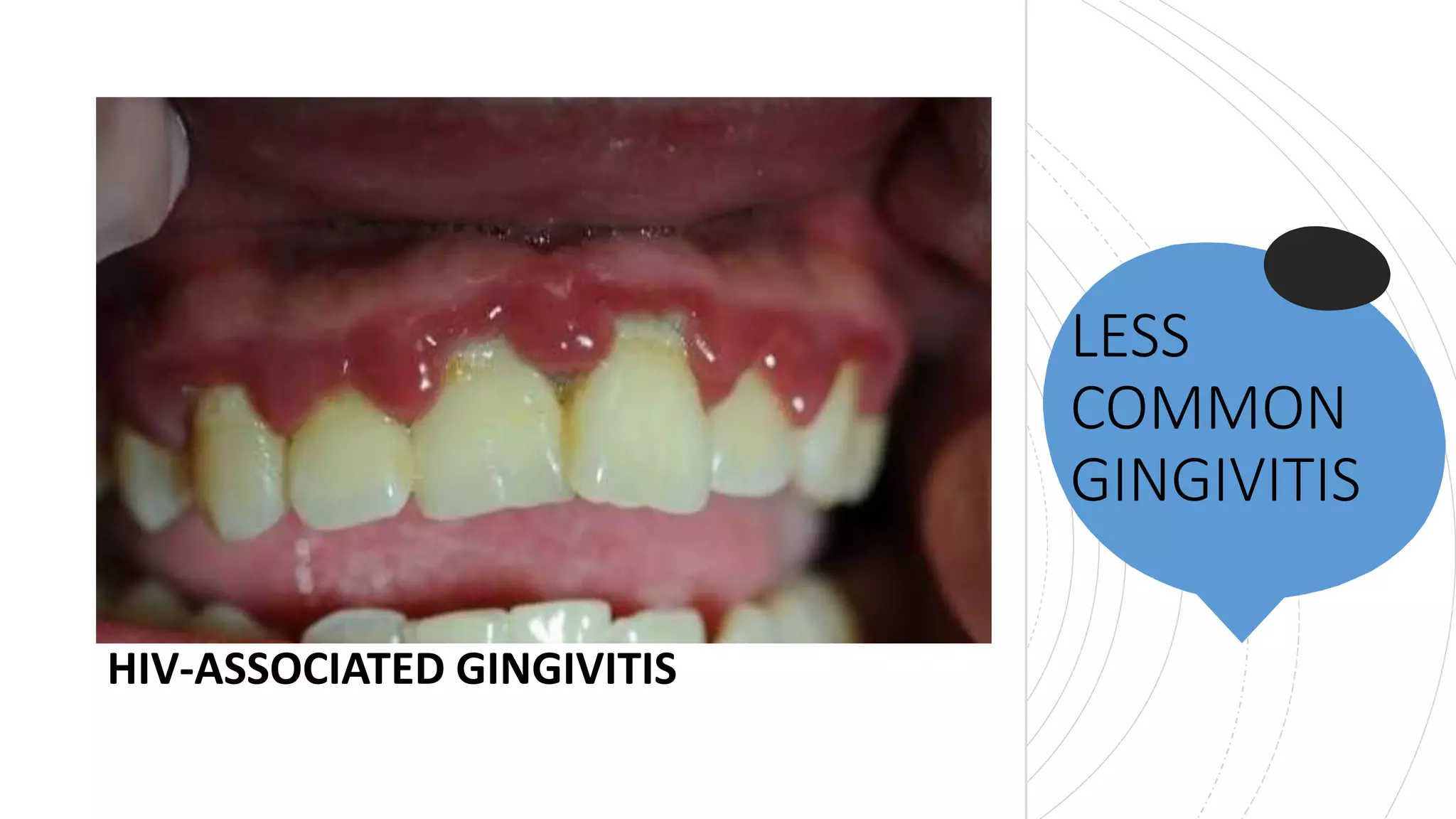 Gingivitis main | PPTX