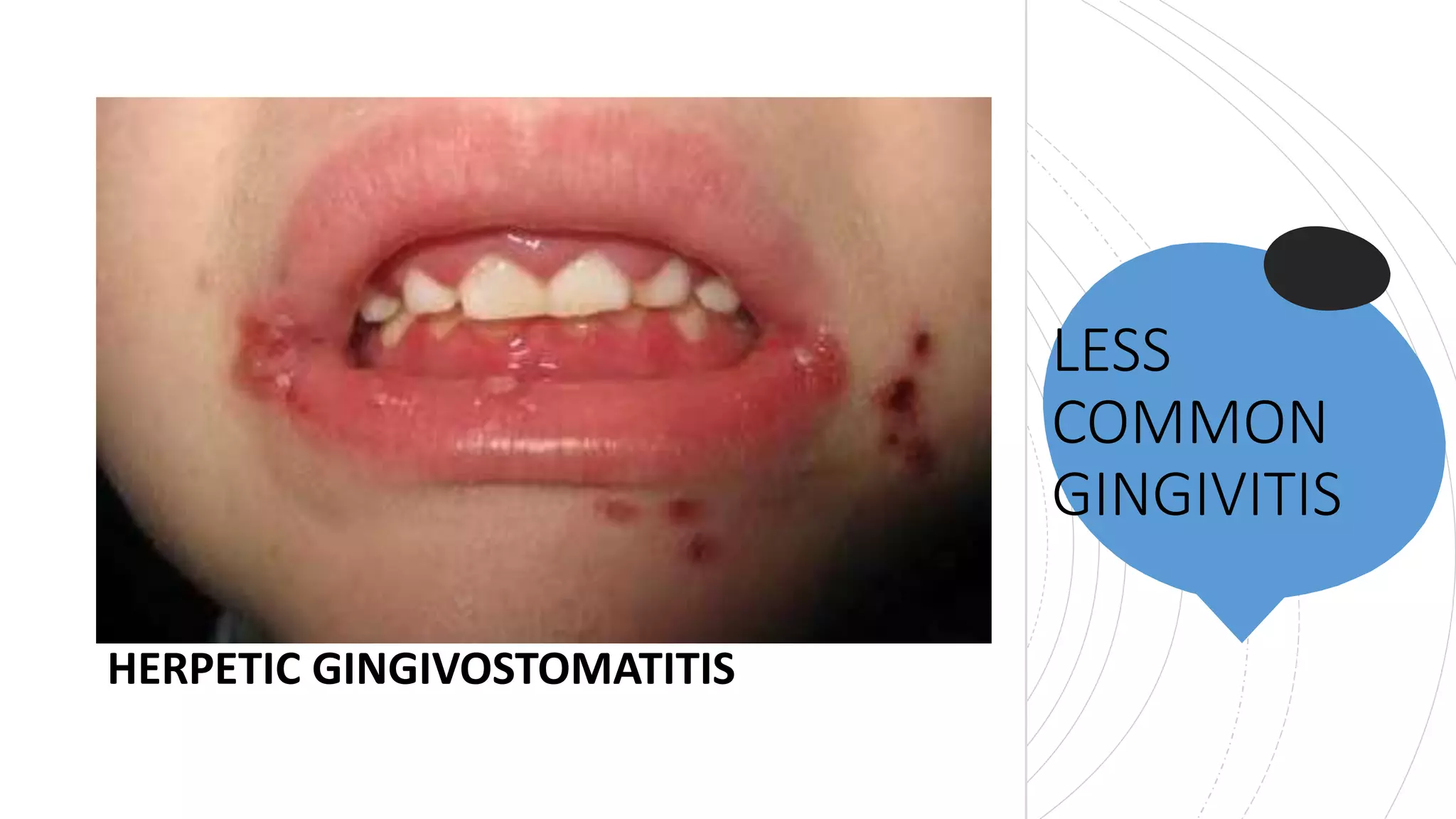 Gingivitis main | PPTX