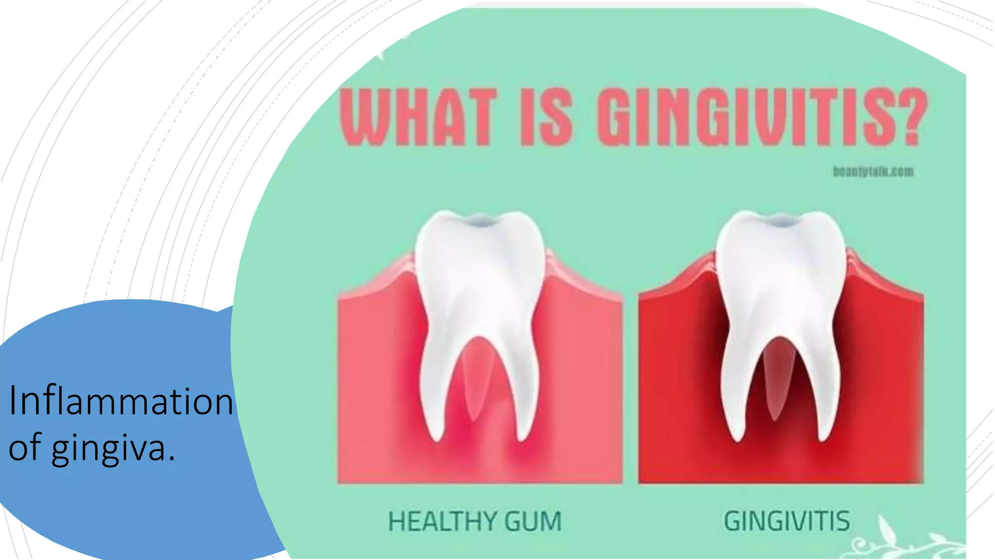 Gingivitis main | PPT