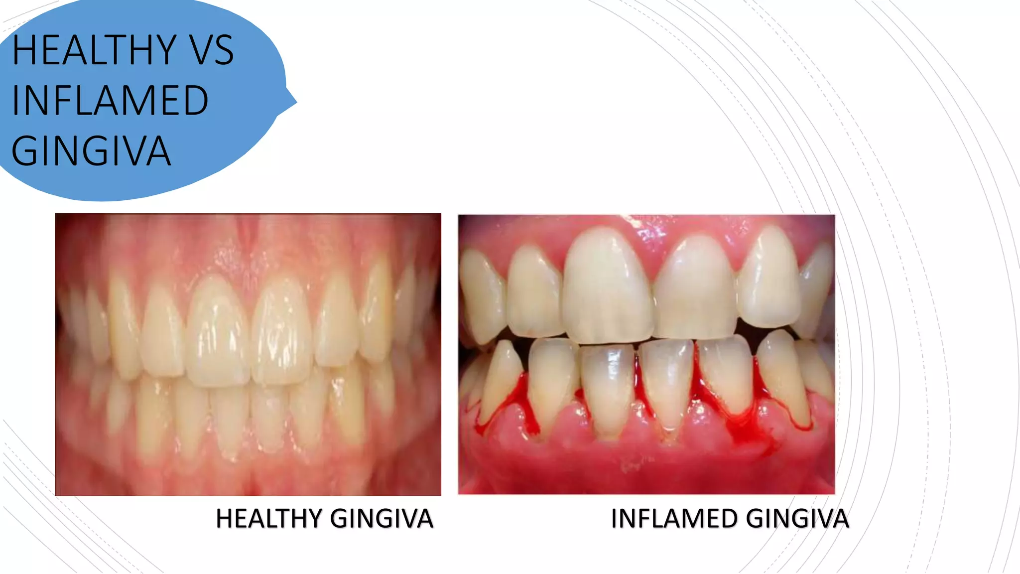 Gingivitis main | PPT