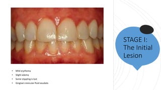 Gingivitis main | PPTX