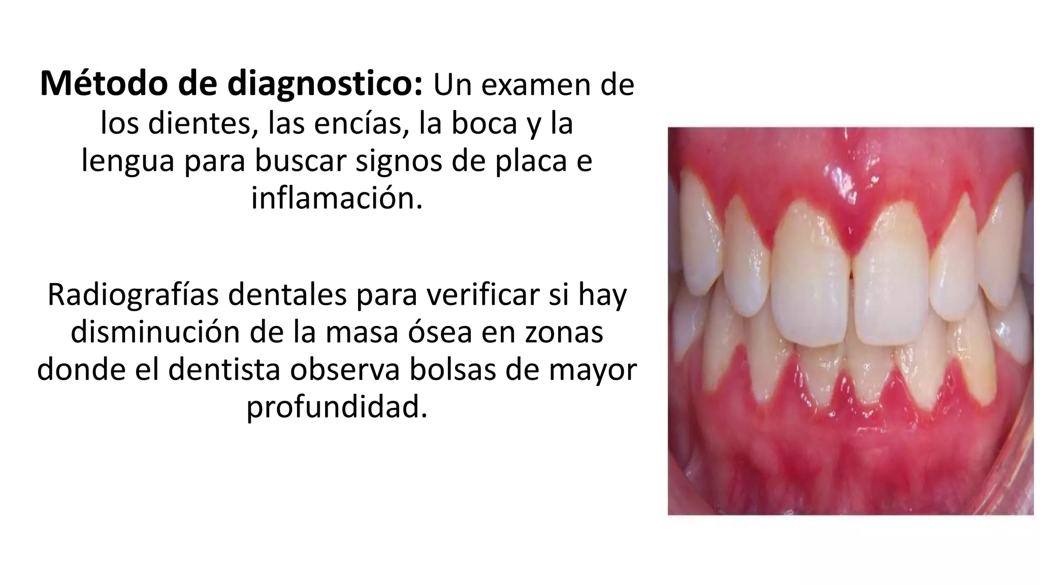 Gingivitis-patologia-bucal.pptx