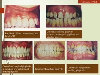 gingivitis- sem 6.pptxNBNBNBNBNNBBNBNBNBNB | PPTX