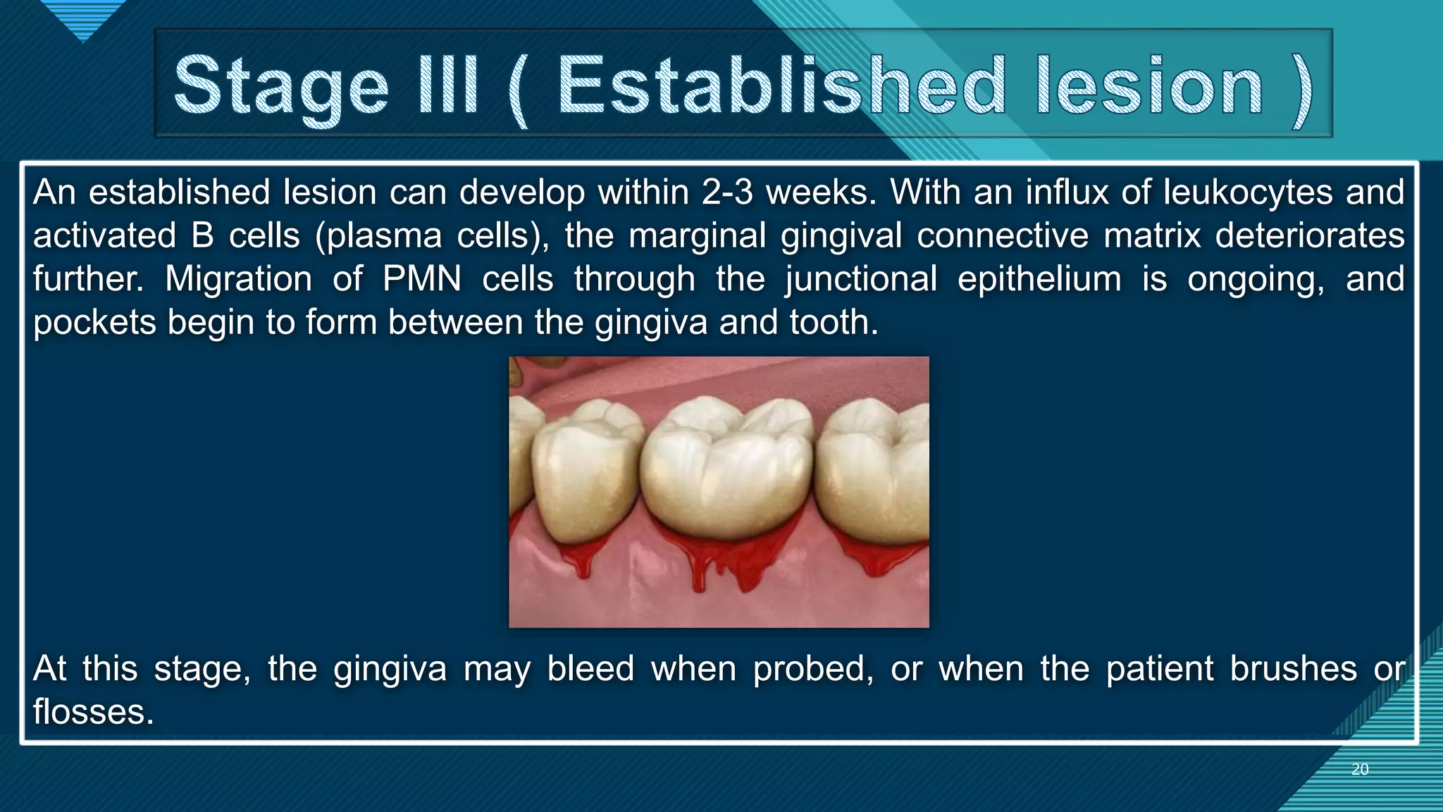 Gingivitis.pptx