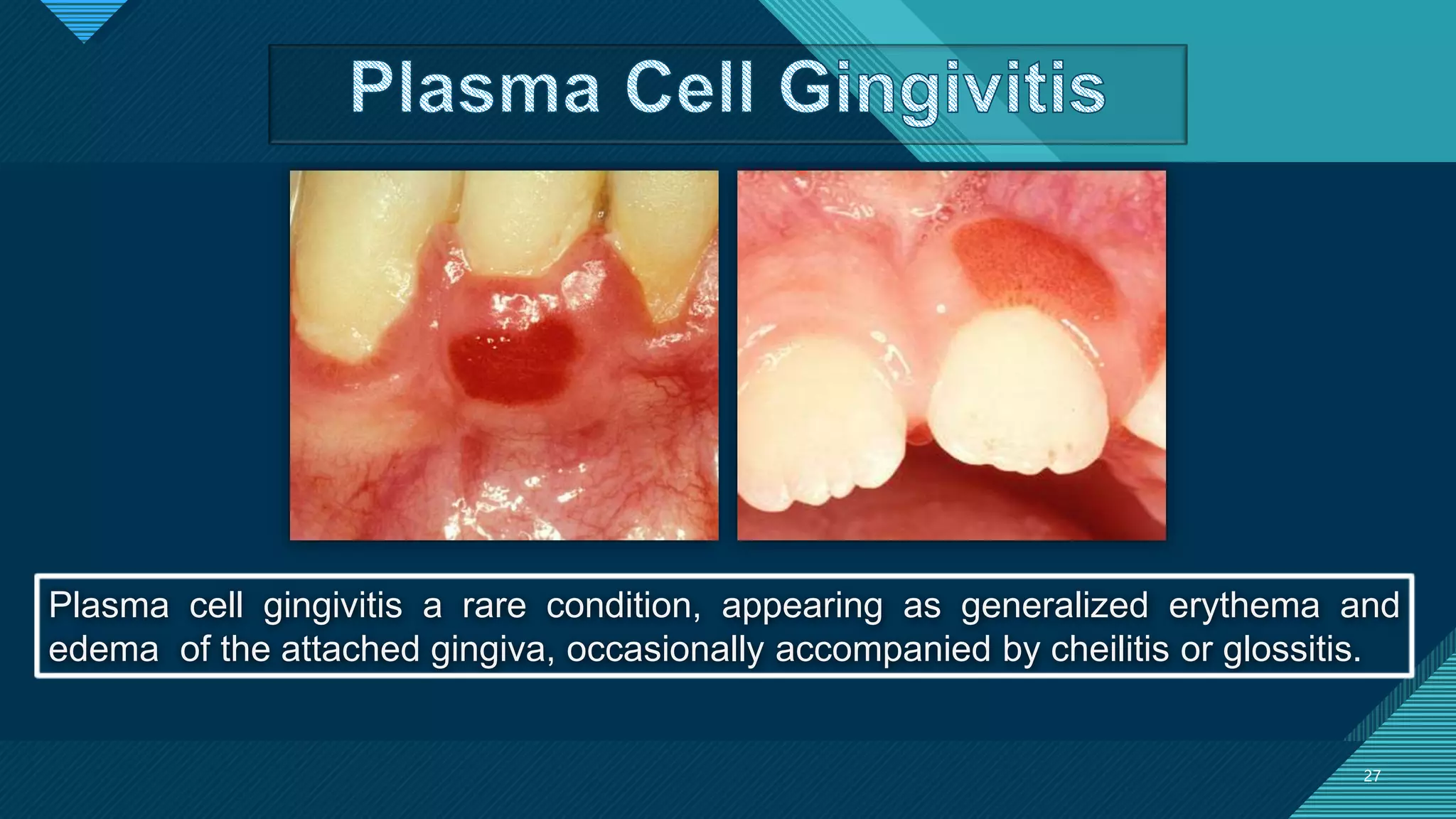 Gingivitis.pptx