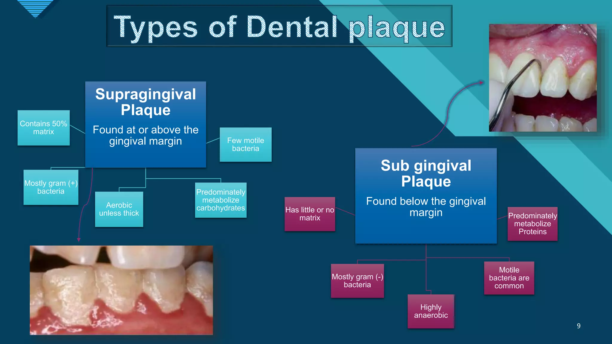 Gingivitis.pptx