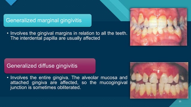 Gingivitis.pptx