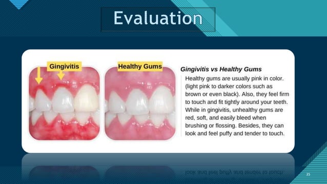 Gingivitis.pptx