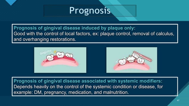 Gingivitis.pptx