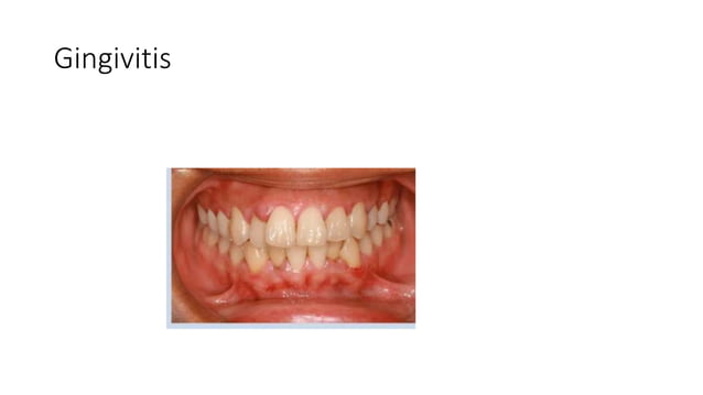 Gingivitis and Periodontal Disease. 1245484543458pptx | PPT