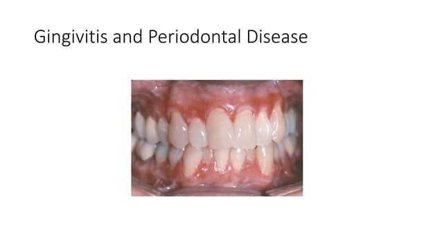 Gingivitis and Periodontal Disease. 1245484543458pptx | PPT