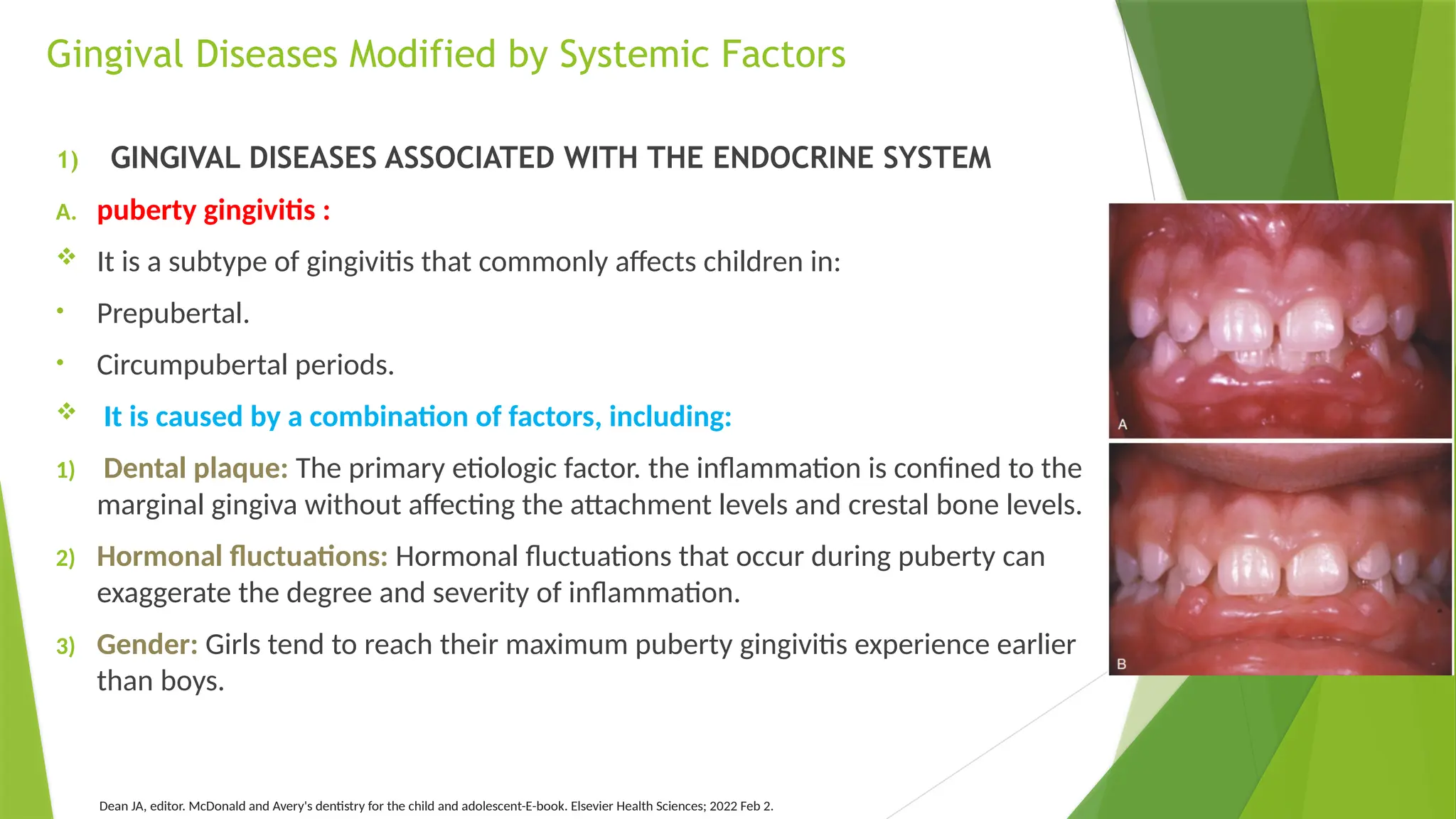 Gingivitis and Periodontal Disease last adjusments.pptx