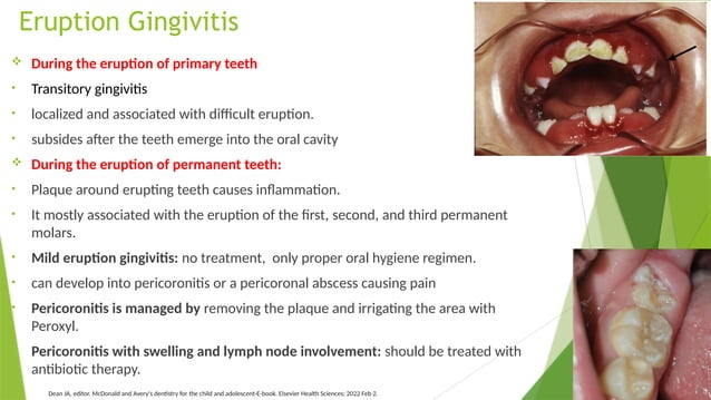 Gingivitis and Periodontal Disease last adjusments.pptx