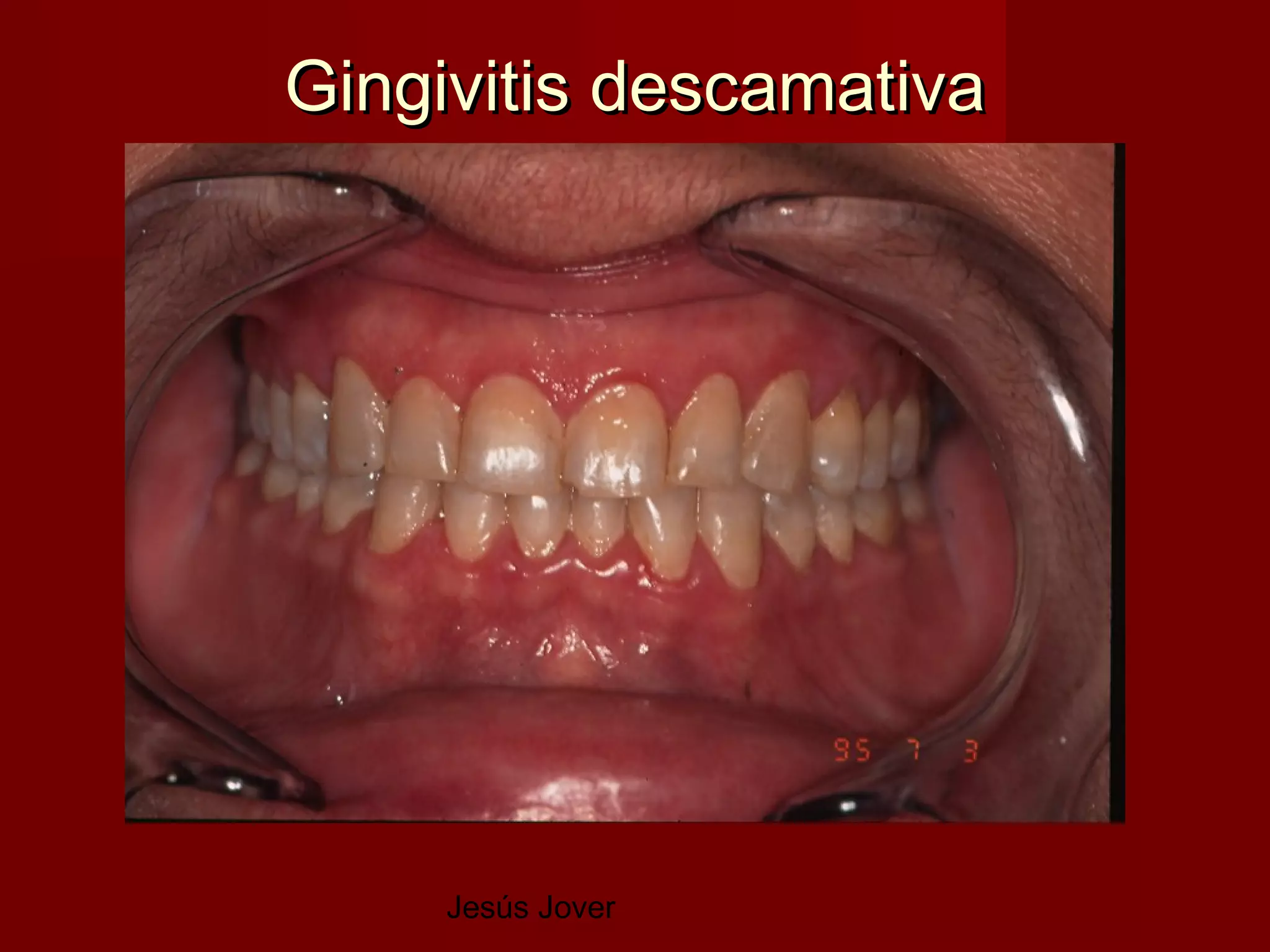 Gingivitis descamativa y gingivitis ulcerada | PPT
