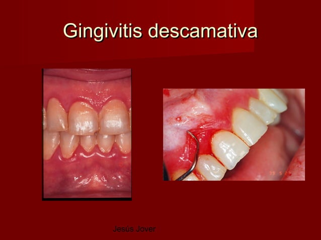 Gingivitis descamativa y gingivitis ulcerada | PPT