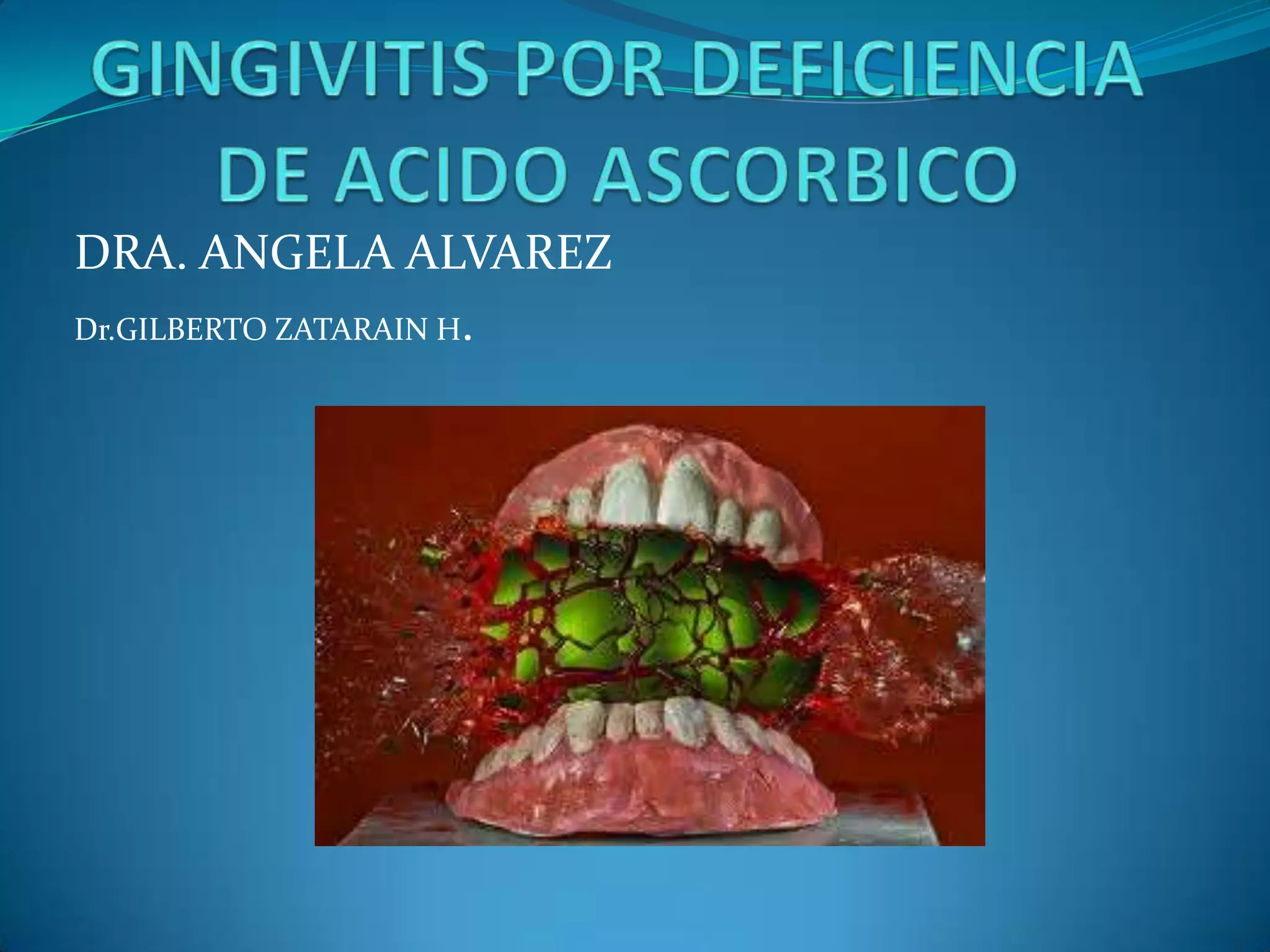 Gingivitis Por Deficiencia De Acido Ascorbico Ppt