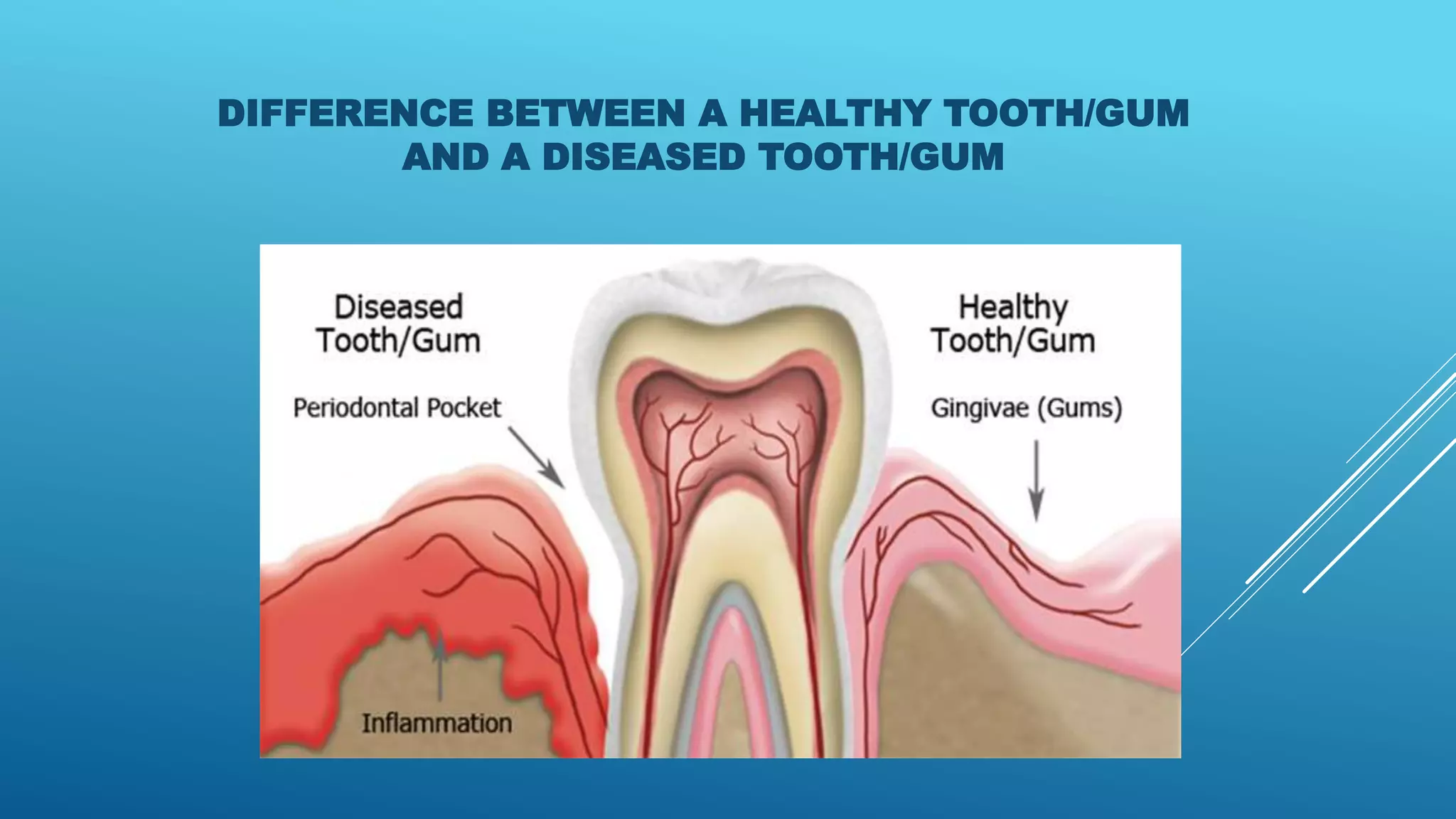 Gingivitis presentation | PPTX