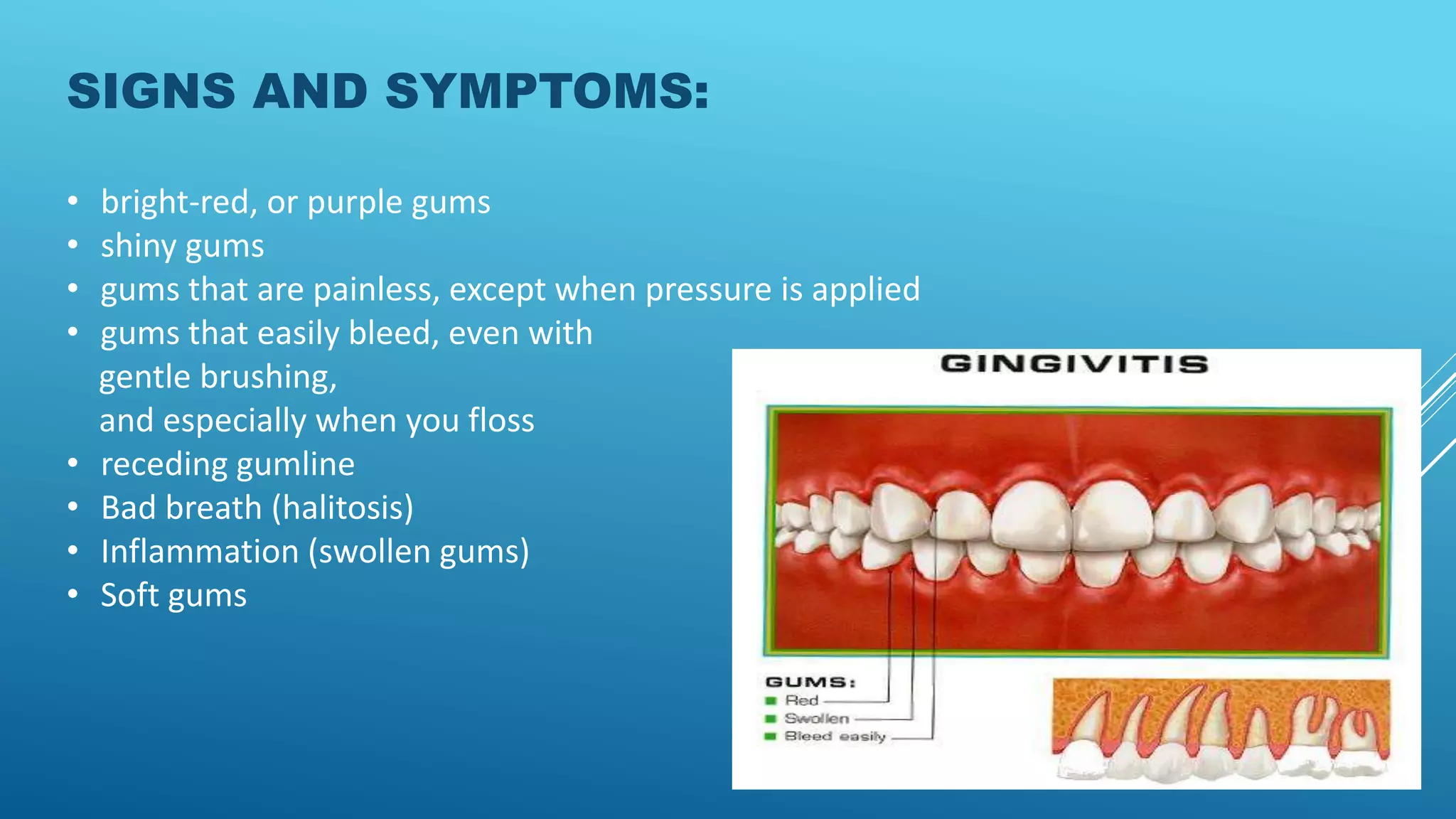 Gingivitis presentation | PPTX