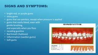 Gingivitis presentation | PPTX