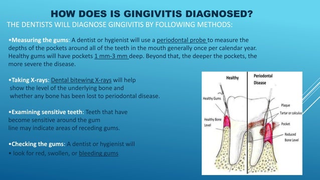 Gingivitis presentation | PPTX | Oral care | Personal Care